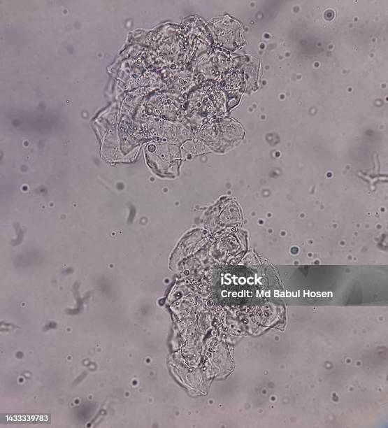 Microscopic Fungi Malassezia Furfur Showing Yeast Cells And Hyphae They Are Associated With