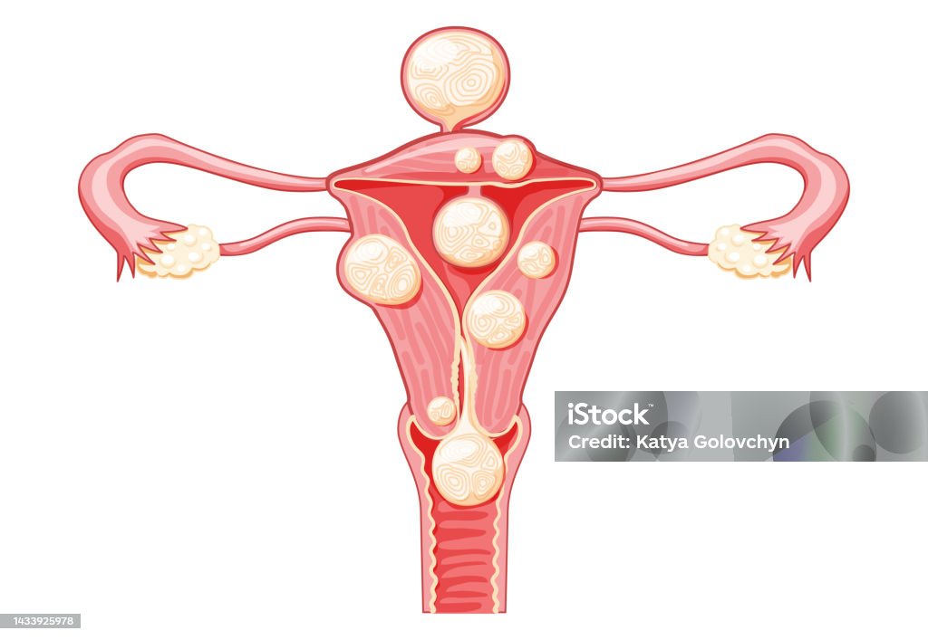 Uterine Fibroids Female Leiomyomas Reproductive System Uterus Front