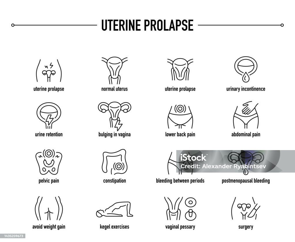 Set Ikon Vektor Prolaps Uterus Ilustrasi Stok Unduh Gambar Sekarang