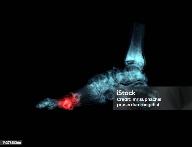 Representación 3d De Los Huesos Del Pie Para El Diagnóstico De Fractura