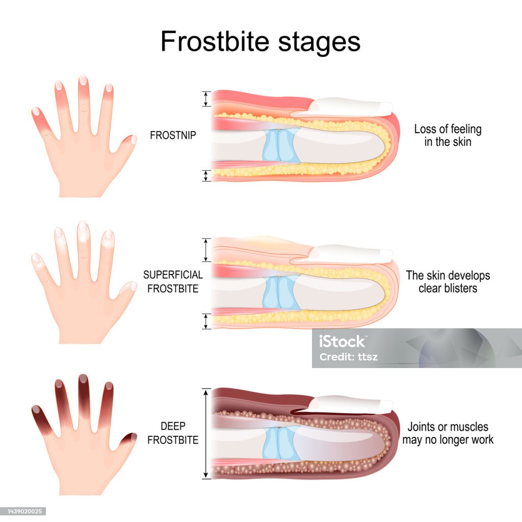 Frostbite Stages Of Fingers Stock Illustration Download Image Now Frost Bite Hand