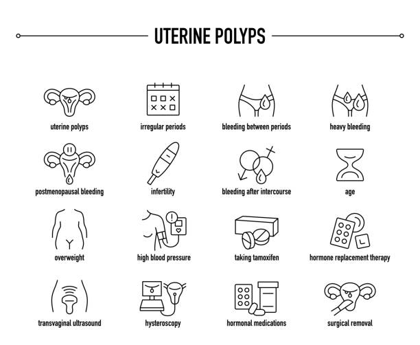 90 Cervical Polyps Stock Illustrations Royalty Free Vector Graphics