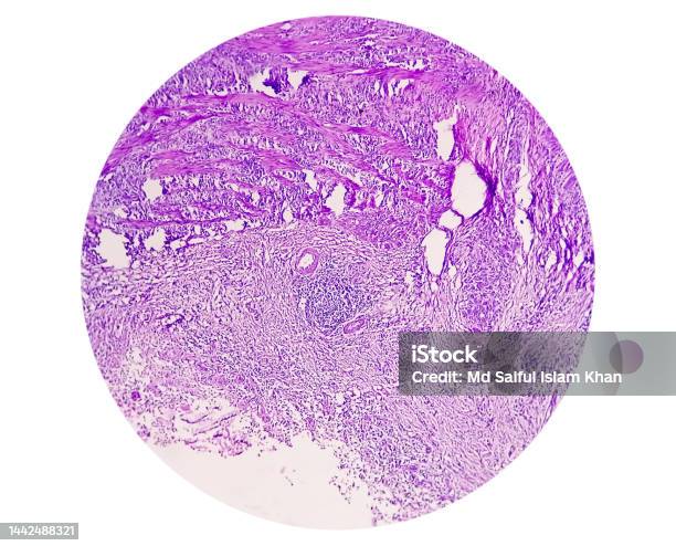 Microscopic Examination Of Thyroglossal Duct Cyst Persistent