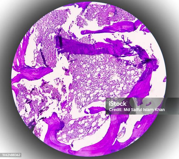 Microscopic Examination Of Thyroglossal Duct Cyst Persistent