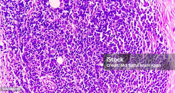 Microscopic Examination Of Thyroglossal Duct Cyst Persistent