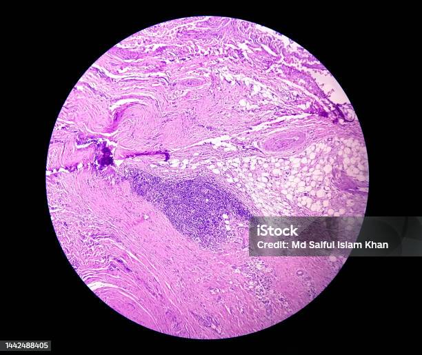 Microscopic Examination Of Thyroglossal Duct Cyst Persistent
