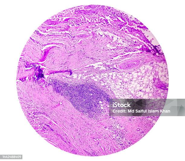 Microscopic Examination Of Thyroglossal Duct Cyst Persistent