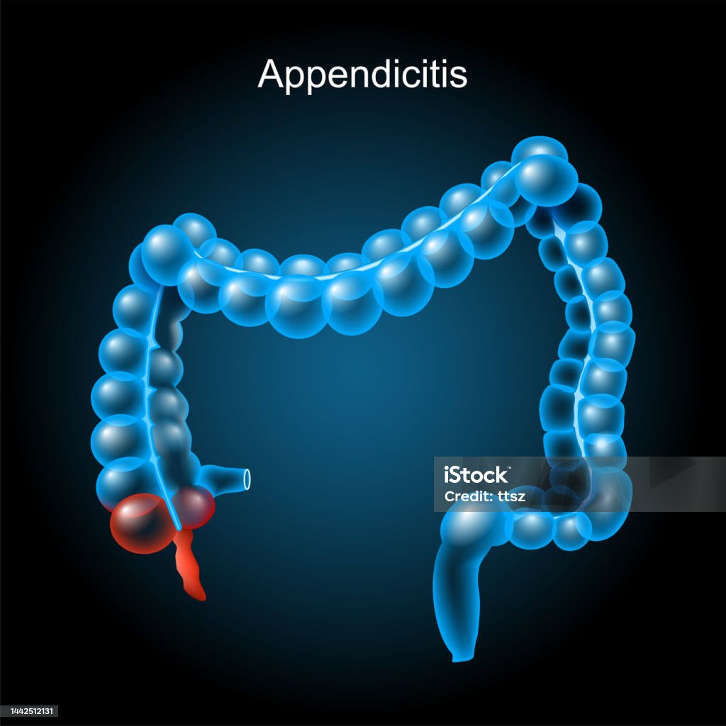 Appendicitis Large Intestine On Dark Background Stock Illustration