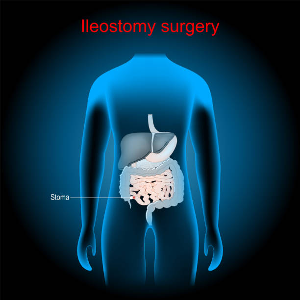 100 Ostomy Equipment Stock Illustrations Royalty Free Vector Graphics