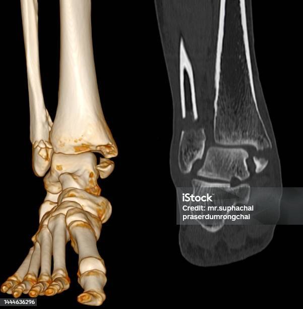 Ct Scan Ankle And Foot Or Computed Tomography Of Ankle Joint And Foot 3d Volume Rendering Image