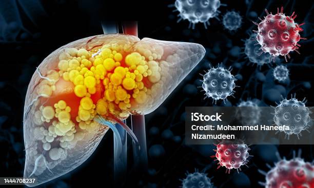 Kanker Hati Atau Tumor Hati Karsinoma Hepatoseluler Penyebab Gejala ... Kanker Hati Atau Tumor Hati Karsinoma Hepatoseluler Penyebab Gejala ...