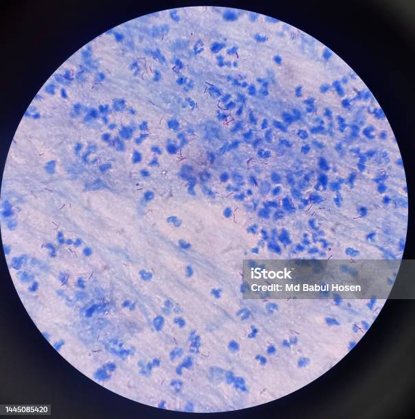 Foto De Imagem Microscópica De 100x Da Coloração Baar Microbactéria Tuberculose Bactéria E Mais