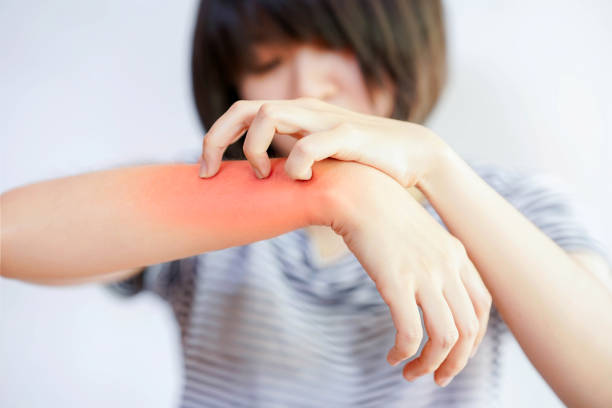 50+ Infected Forearm From Mosquito Bite Stock Photos, Pictures ... 50+ Infected Forearm From Mosquito Bite Stock Photos, Pictures ...