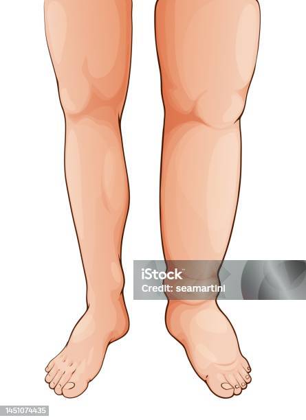 Edema Lymphedema Disease Swollen Leg And Foot-vektorgrafik och fler ... Edema Lymphedema Disease Swollen Leg And Foot-vektorgrafik och fler ...