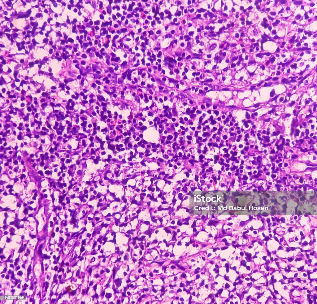 Lymph Node Hodgkins Lymphoma Mixed Cellularity Monotonous Population Of Lymphocytes Histiocytes