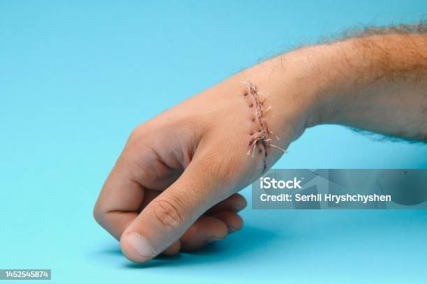 Suture Wound On Hand Pain Of Accident Concept Stock Photo - Download ... Suture Wound On Hand Pain Of Accident Concept Stock Photo - Download ...