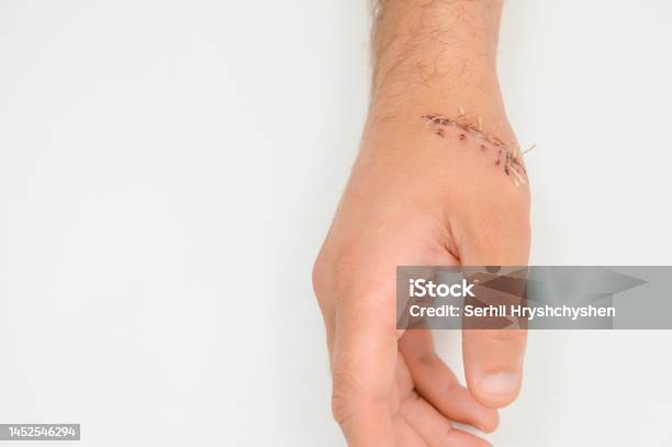 Suture Wound On Hand Pain Of Accident Concept Stock Photo - Download ... Suture Wound On Hand Pain Of Accident Concept Stock Photo - Download ...