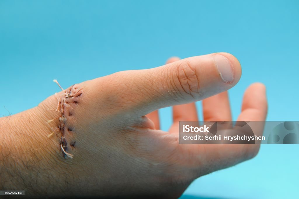 Suture Wound On Hand Pain Of Accident Concept Stock Photo - Download ... Suture Wound On Hand Pain Of Accident Concept Stock Photo - Download ...