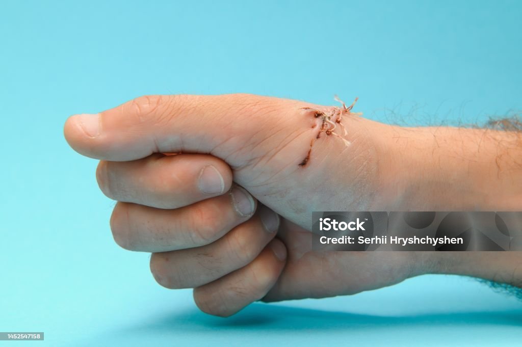 Suture Wound On Hand Pain Of Accident Concept Stock Photo - Download ... Suture Wound On Hand Pain Of Accident Concept Stock Photo - Download ...