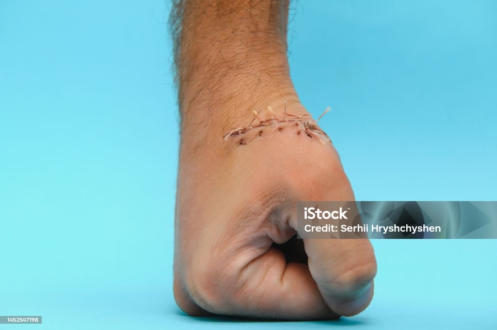 Suture Wound On Hand Pain Of Accident Concept Stock Photo - Download ... Suture Wound On Hand Pain Of Accident Concept Stock Photo - Download ...