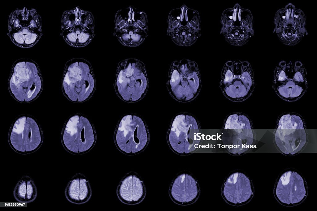 Mri Brain Axial Views To Evaluar El Tumor Cerebral Glioblastoma Masa De Isodensidad De