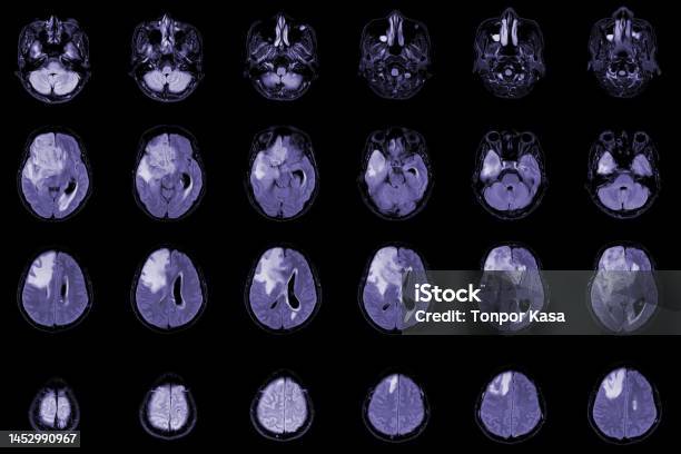 Mri Brain Axial Views To Evaluate Brain Tumor Glioblastoma Brain Metastasis Isodensity Mass With