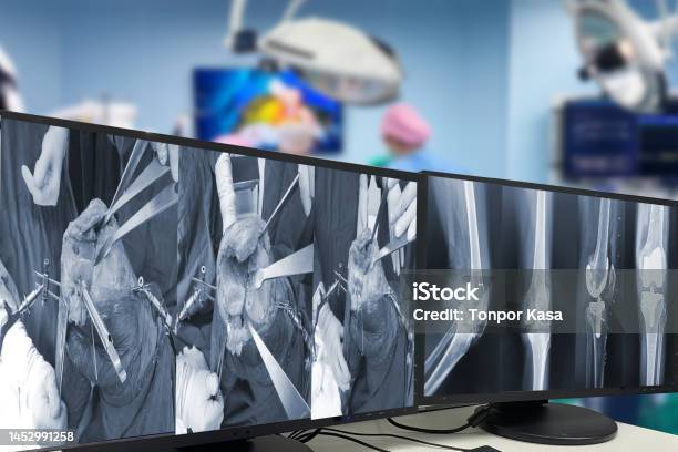Rontgen Lutut Dokter Buram Melakukan Penggantian Lutut Total Di Latar ... Rontgen Lutut Dokter Buram Melakukan Penggantian Lutut Total Di Latar ...