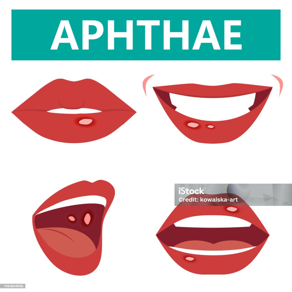 Aphthous Ulcers On Mouth Close Up Vector Illustration Cartoon Flat Design Clip Art Stock