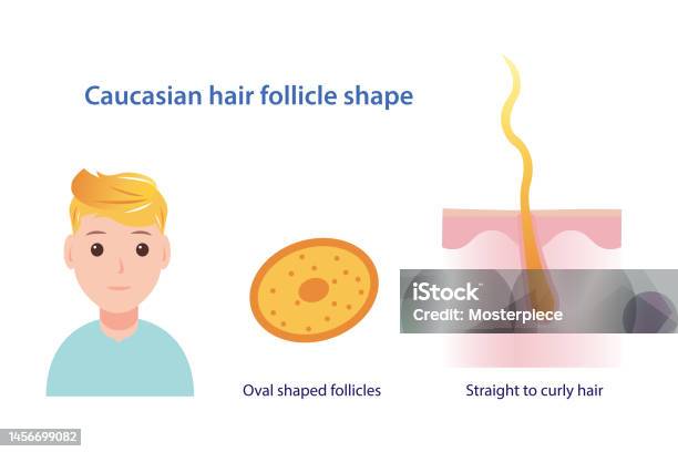 Infographic Of Caucasian Hair Follicle Shape Vector Illustration