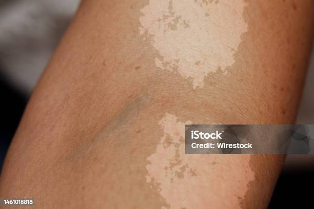 Tampilan Closeup Di Lengan Seseorang Yang Menderita Tinea Versicolor ... Tampilan Closeup Di Lengan Seseorang Yang Menderita Tinea Versicolor ...