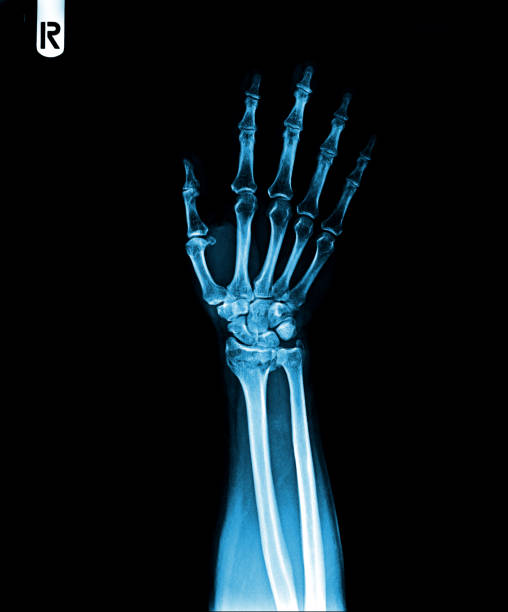 280+ Comminuted Fracture Stock Photos, Pictures & Royalty-Free Images ... 280+ Comminuted Fracture Stock Photos, Pictures & Royalty-Free Images ...