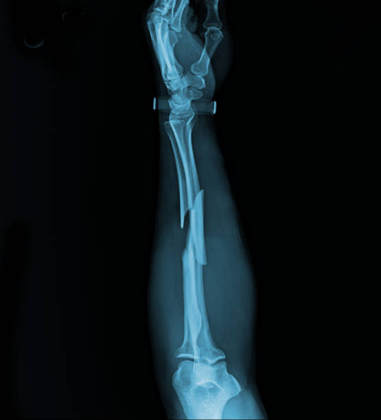 280+ Comminuted Fracture Stock Photos, Pictures & Royalty-Free Images ... 280+ Comminuted Fracture Stock Photos, Pictures & Royalty-Free Images ...