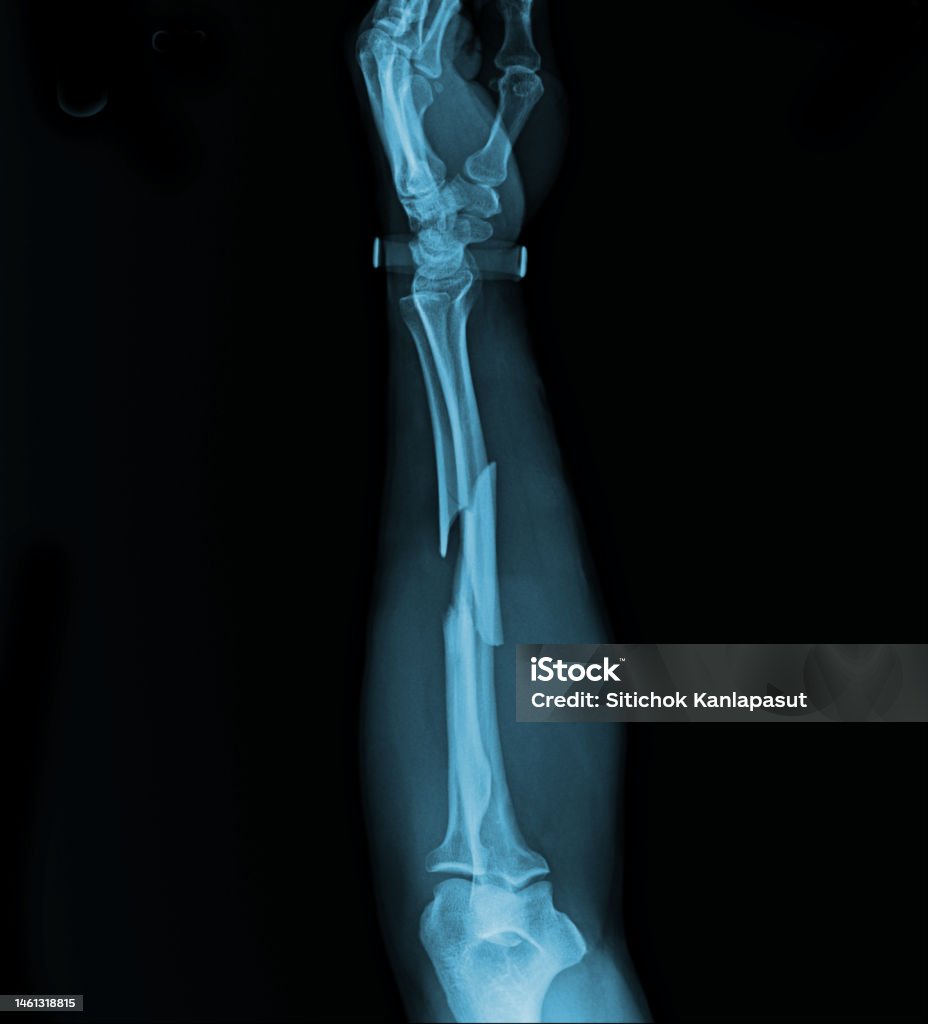 Foto De Radiografia Do Antebraço Eixo De Fratura Cominutivo Do Osso