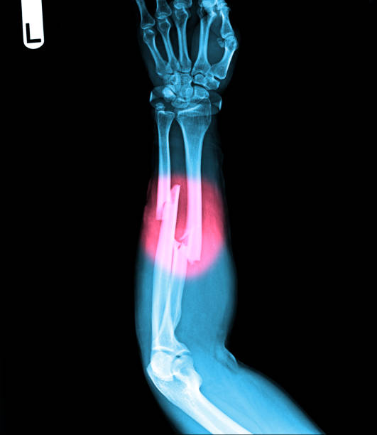 280+ Comminuted Fracture Stock Photos, Pictures & Royalty-Free Images ... 280+ Comminuted Fracture Stock Photos, Pictures & Royalty-Free Images ...