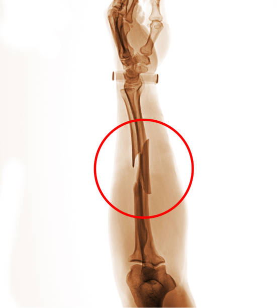 280+ Comminuted Fracture Stock Photos, Pictures & Royalty-Free Images ... 280+ Comminuted Fracture Stock Photos, Pictures & Royalty-Free Images ...