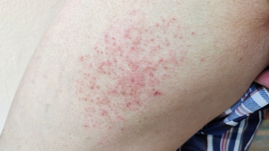 The Inflammation Skin And Rash Hives Itchy Skin On The Leg 照片檔及更多 一個人