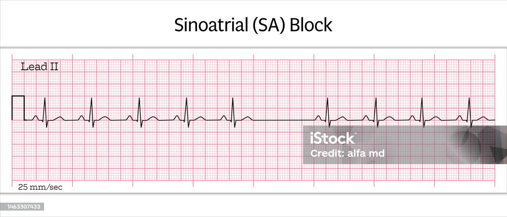 Sinoatrial Blok Ekg Kertas Ekg 8 Detik Ilustrasi Stok Unduh Gambar