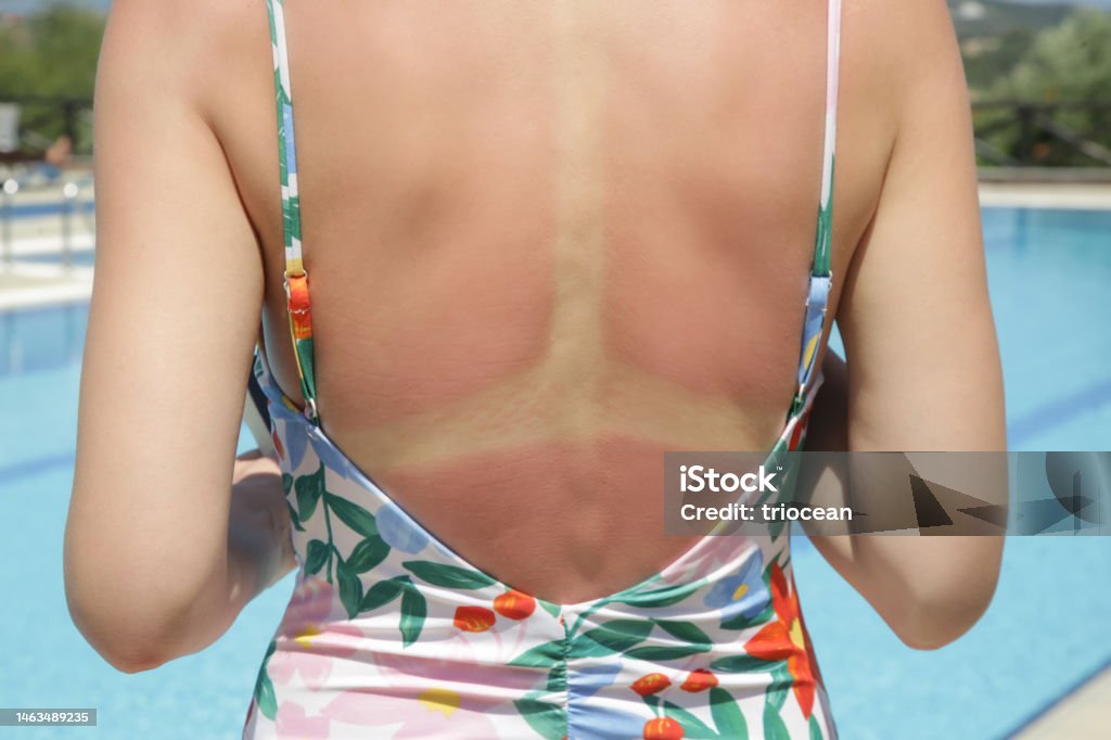 Sunburn And Skin Care Concept Young Woman With Red Sunburned Skin On