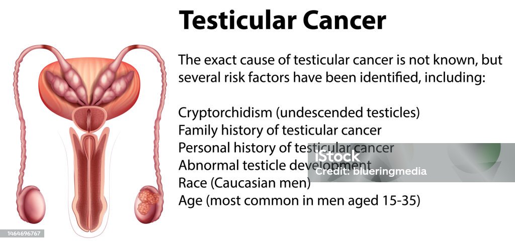 Infographie Sur Le Cancer Du Testicule Avec Explication Vecteurs Libres