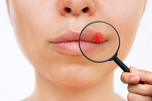 Herpes En El Labio Mujer Joven Con Ampollas Causadas Por Virus En La