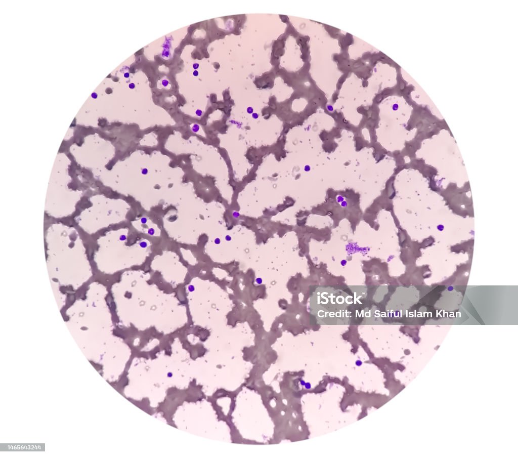 Blood Film Or Peripheral Blood Smear Microcytic Hypochromic Anemia With ... Blood Film Or Peripheral Blood Smear Microcytic Hypochromic Anemia With ...