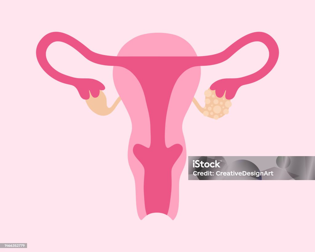 Polycystic Ovary Syndrome Female Reproductive System With Ovarian Cysts Stock Illustration