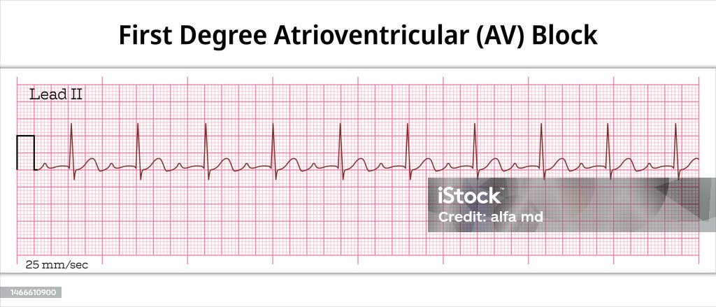 Blok Atrioventrikular Tingkat Pertama Ekg Blok Av Tingkat 1 8 Kertas ... Blok Atrioventrikular Tingkat Pertama Ekg Blok Av Tingkat 1 8 Kertas ...