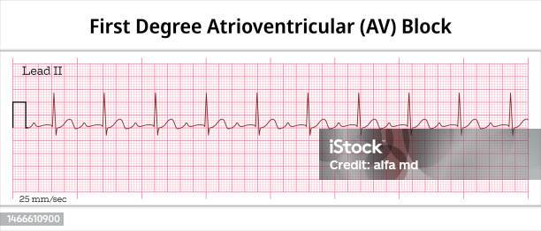 Ekg Blok Przedsionkowokomorowy Pierwszego Stopnia Blok Av 1 Stopnia ... Ekg Blok Przedsionkowokomorowy Pierwszego Stopnia Blok Av 1 Stopnia ...