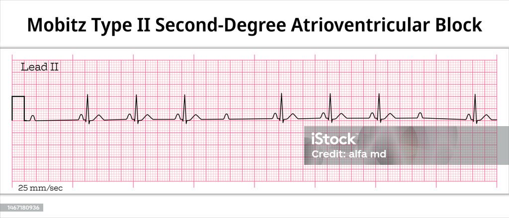 Ekg Mobitz Typ 2 Blok Przedsionkowokomorowy Drugiego Stopnia Blok Av 2 ... Ekg Mobitz Typ 2 Blok Przedsionkowokomorowy Drugiego Stopnia Blok Av 2 ...