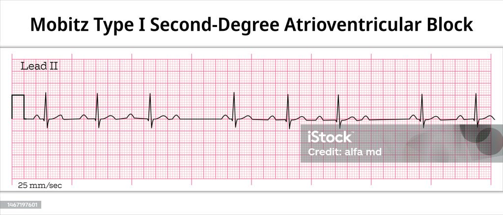 Ekg Mobitz Tipe 1 Blok Atrioventrikular Tingkat Kedua Blok Av Tingkat 2 ... Ekg Mobitz Tipe 1 Blok Atrioventrikular Tingkat Kedua Blok Av Tingkat 2 ...