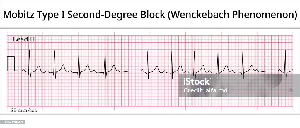Fenomen Wenckebacha Ekg Mobitz Typu 1 Blok Przedsionkowokomorowy ... Fenomen Wenckebacha Ekg Mobitz Typu 1 Blok Przedsionkowokomorowy ...