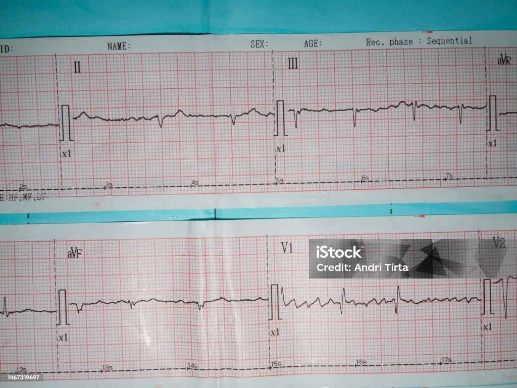 Gambar Elektrokardiogram Atau Ekg Yang Menggambarkan Kelainan Irama ... Gambar Elektrokardiogram Atau Ekg Yang Menggambarkan Kelainan Irama ...