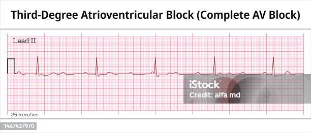 Blok Atrioventrikular Tingkat Ketiga Ekg Blok Av Lengkap Kertas Ekg ... Blok Atrioventrikular Tingkat Ketiga Ekg Blok Av Lengkap Kertas Ekg ...