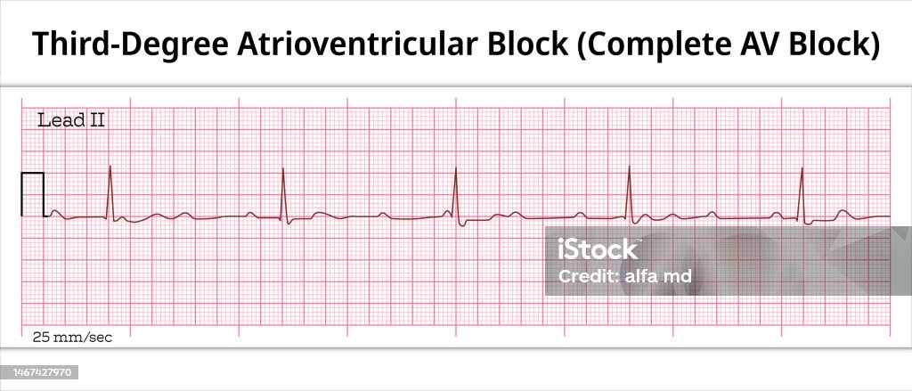 Ecg Third Degree Atrioventricular Block Complete Av Block 8 Second Ecg ... Ecg Third Degree Atrioventricular Block Complete Av Block 8 Second Ecg ...
